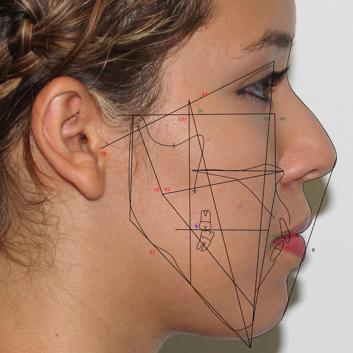 Extracciones Biprotrusión Maxilar – Docteur Marin